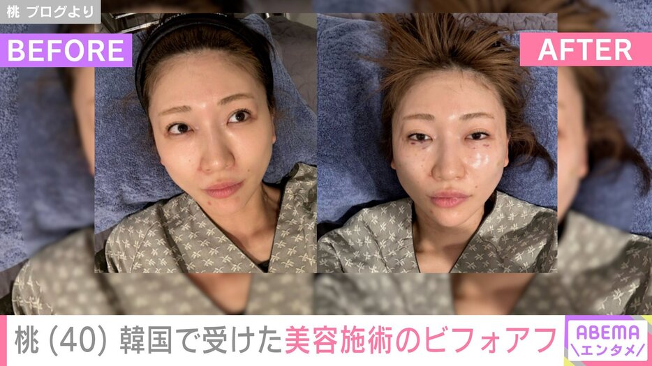 “3度の二重整形” 桃（40）、 韓国で顔の美容施術受けたビフォアフ公開 帰国時にはまさかの出来事 (ABEMA TIMES) - Yahoo!ニュース