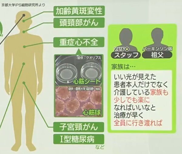 iPS細胞で「ドーパミン」が……“パーキンソン病”にも効果、実用化は？ 患者の家族「いい光が見えた」「早く全員に」 (日テレNEWS NNN) - Yahoo!ニュース