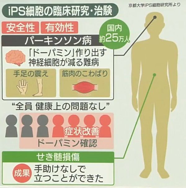iPS細胞で「ドーパミン」が……“パーキンソン病”にも効果、実用化は？ 患者の家族「いい光が見えた」「早く全員に」 (日テレNEWS NNN) - Yahoo!ニュース